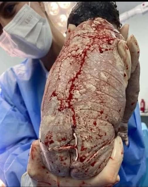 😱😱Baby born with an DIU peg… See more - Breaking News