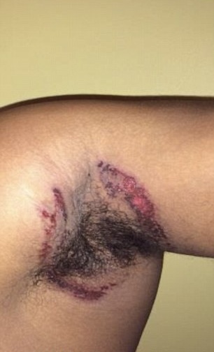 Severe armpit rashes treatment - Breaking News