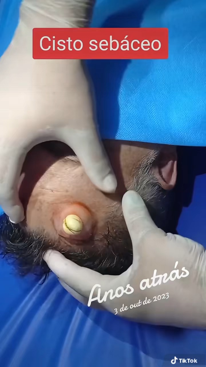 how to treat sebaceous cyst forehead - Breaking News